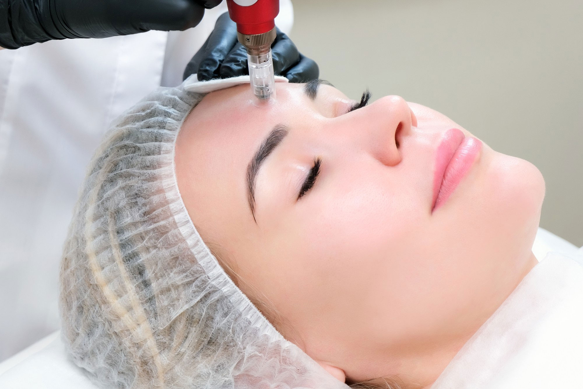 Microneedling - Huntington Healing by Angela Moryc Flyntz